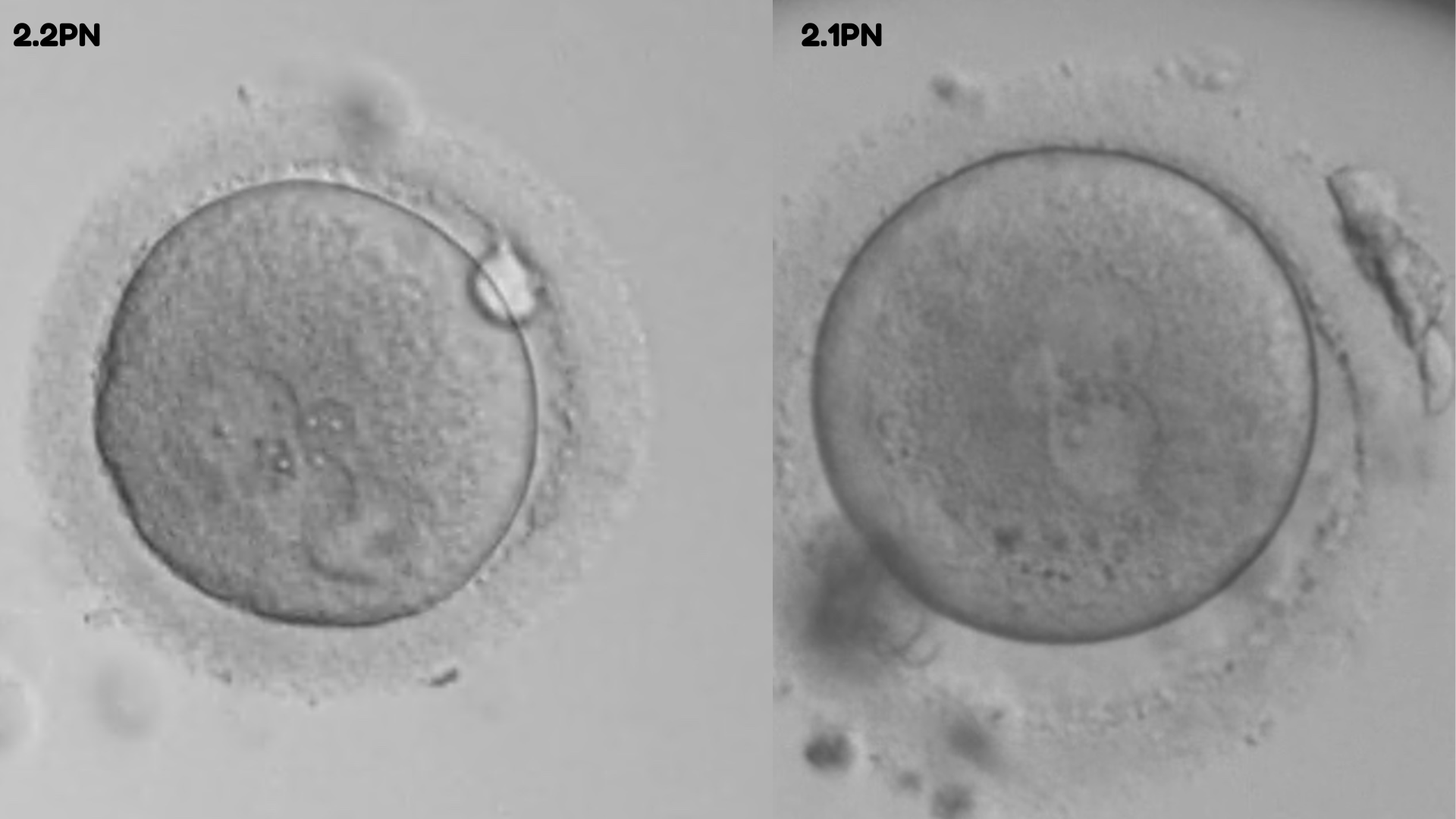 Responsible IVF: The missed opportunity of abnormally fertilised embryos